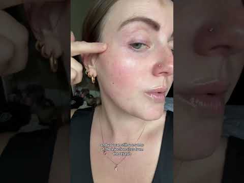 My face still looks pretty ruddy, but nothing to hide - YouTube