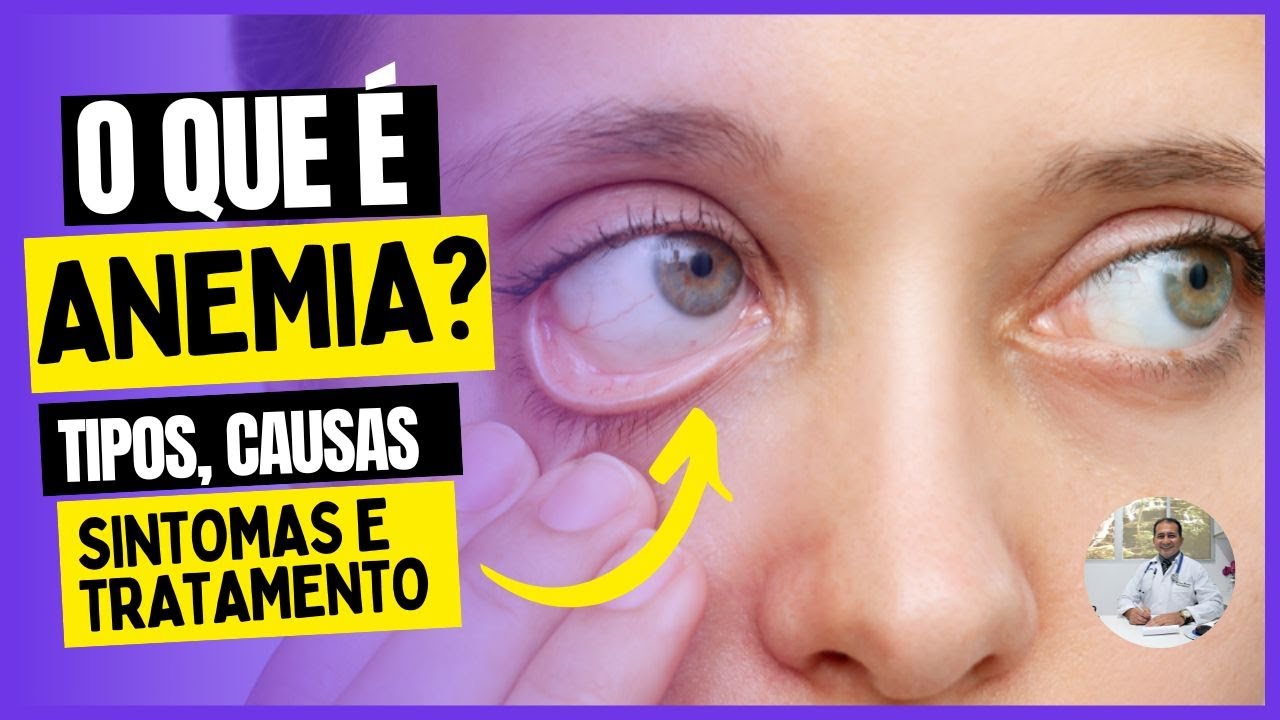 ANEMIA: TIPOS, CAUSAS, SINTOMAS E TRATAMENTO. - YouTube