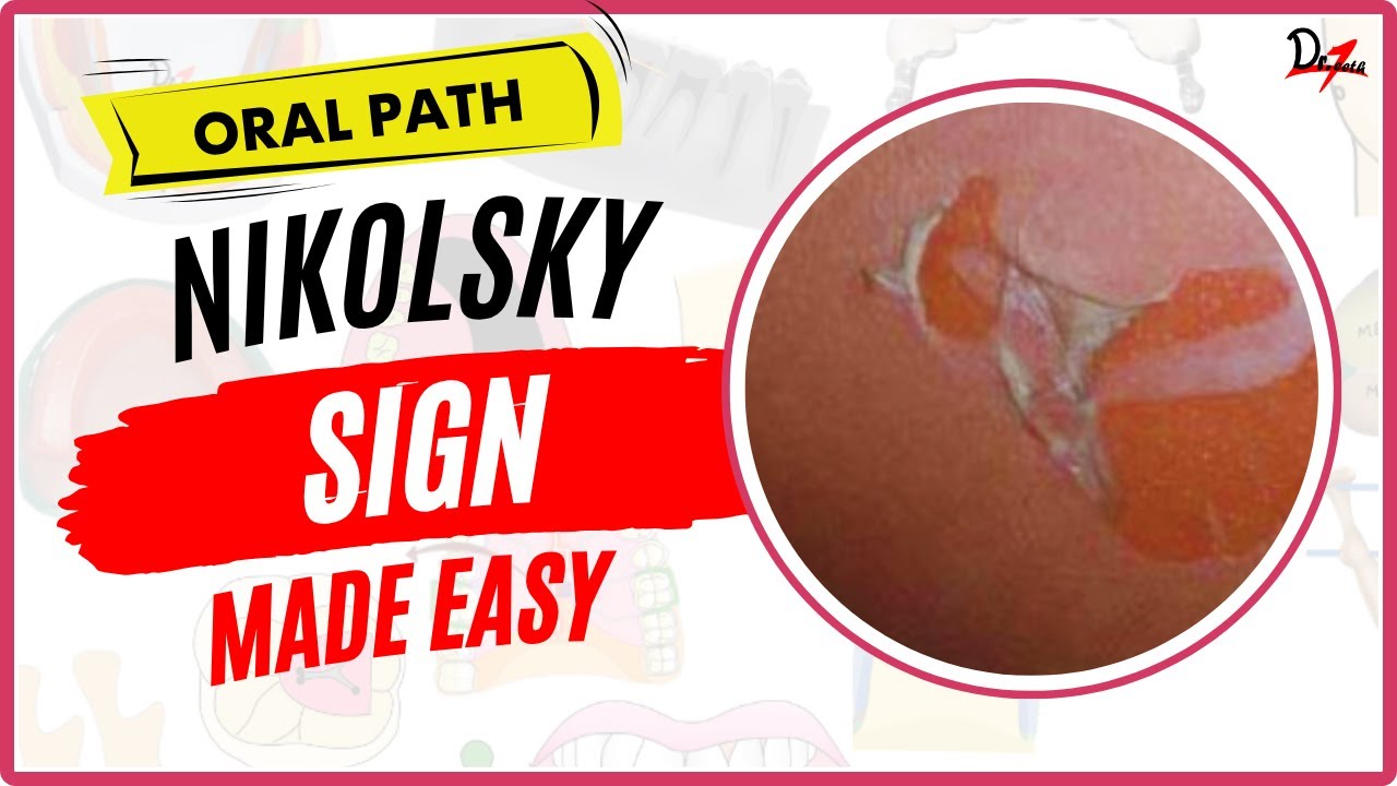 What the Nikolsky Sign Tells Us! - YouTube