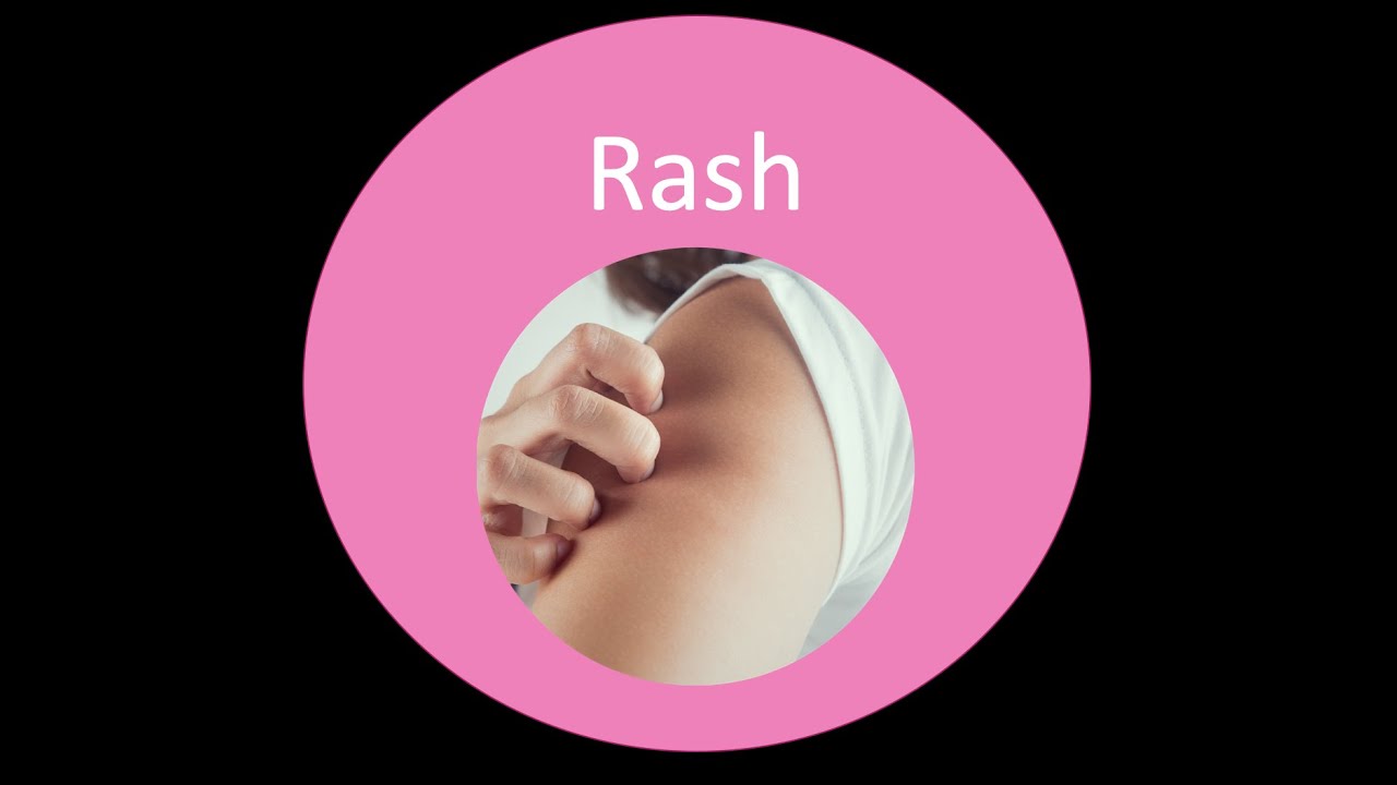 Clinicasl History in English: Skin rash - YouTube