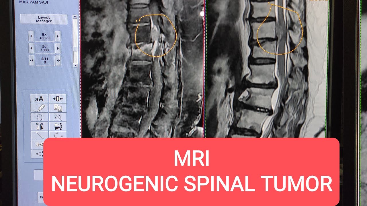 Intradural Extramedullary Neurogenic Spinal Tumor - Neurofibroma - MRI ...
