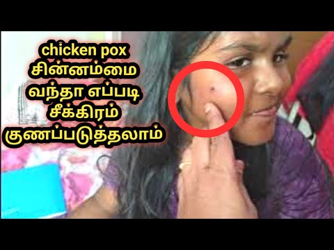 Chicken Pox || how to get rid of chicken pox quickly || chicken pox ...