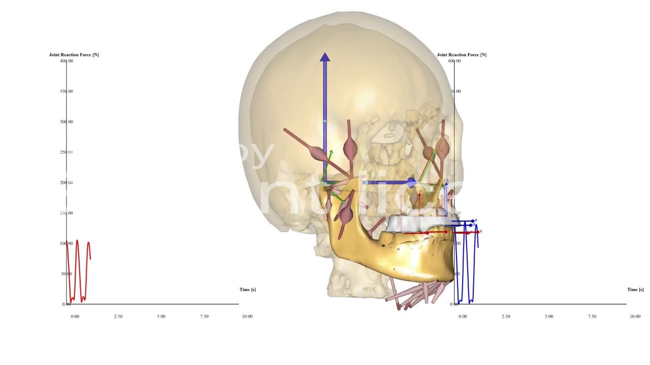 Patient-specific musculoskeletal simulation of the human masticatory ...