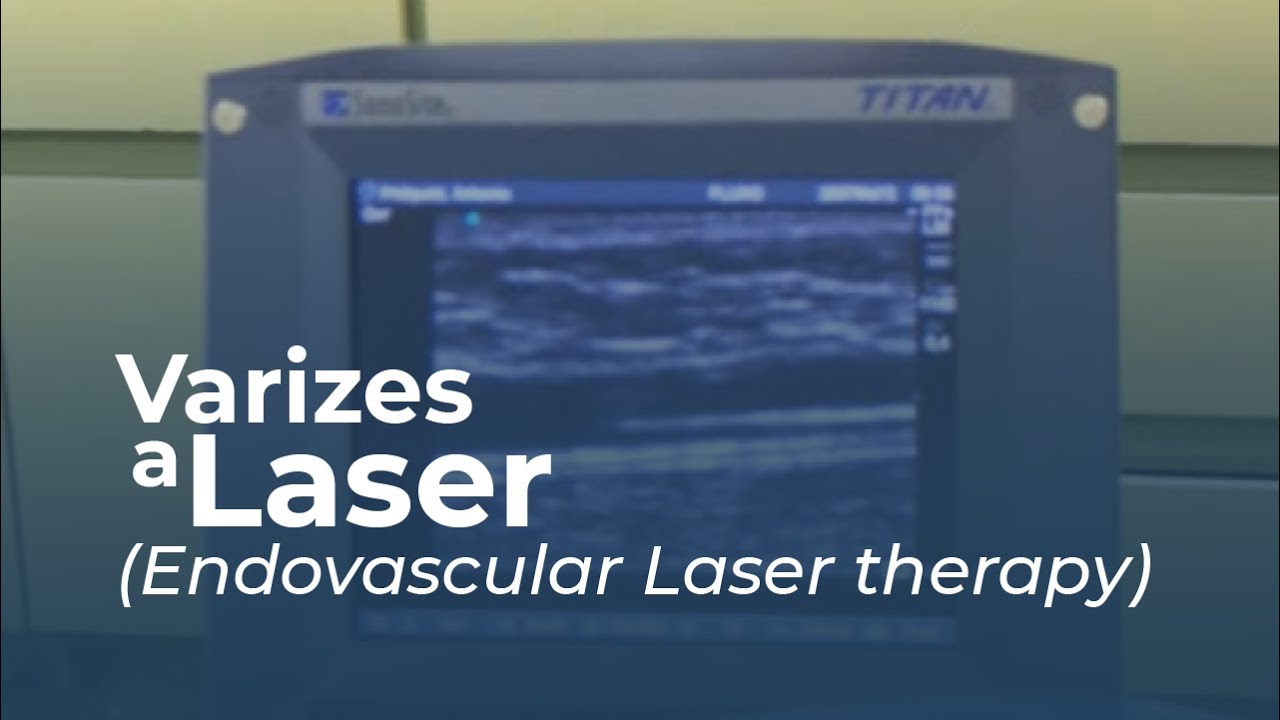 Varizes a Laser (Endovascular Laser Therapy) - YouTube