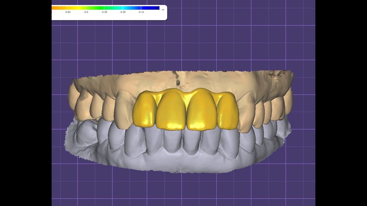 Upper anterior designing with preop scan in exocad - YouTube