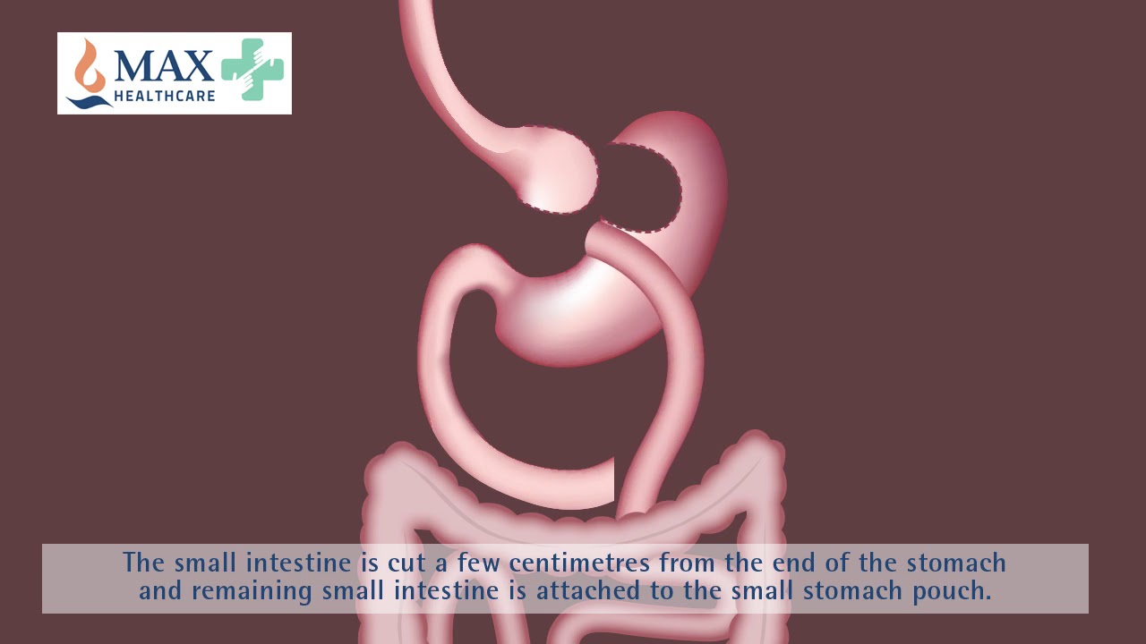 A quick video to explain how Bariatric Roux en Y gastric bypass works ...