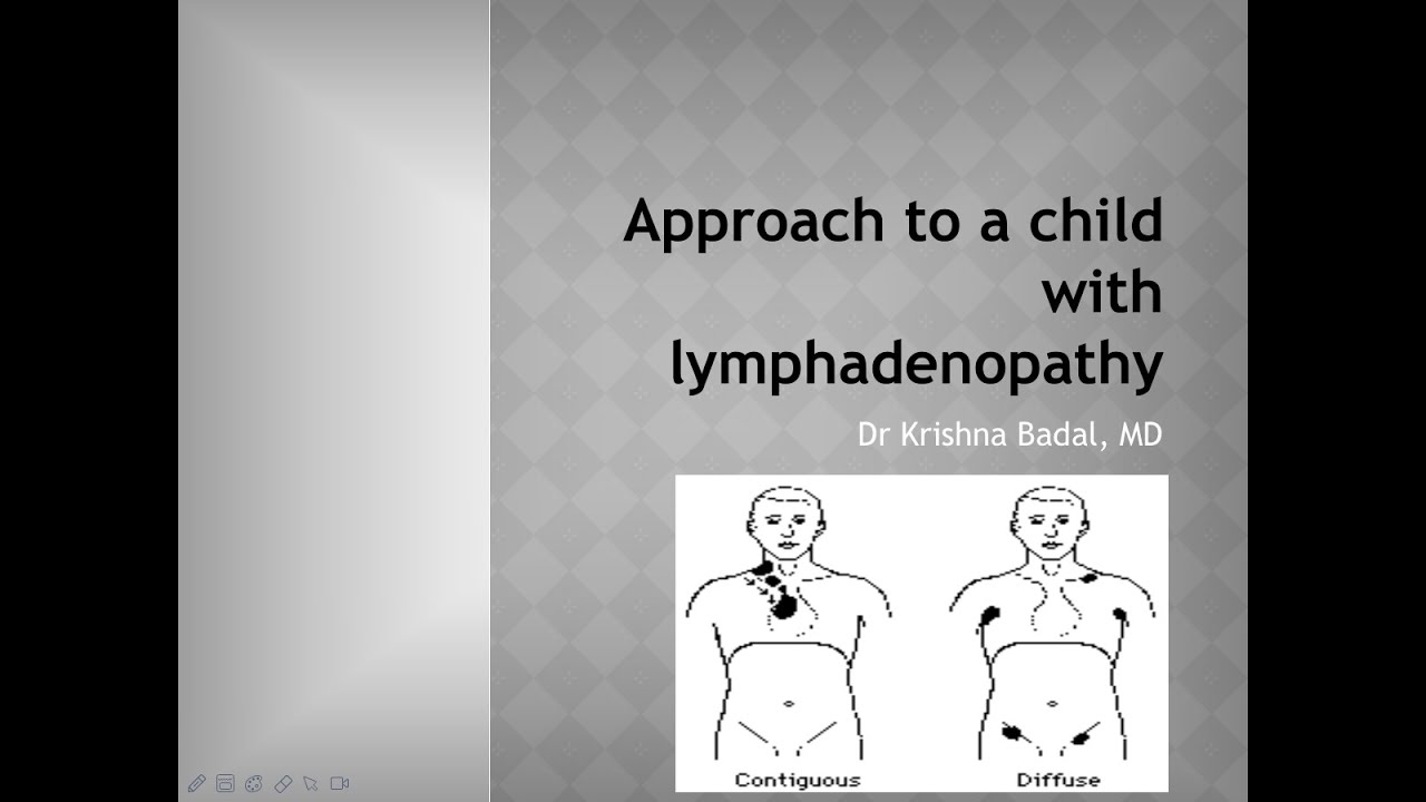 Approach to a child with lymphadenopathy - YouTube