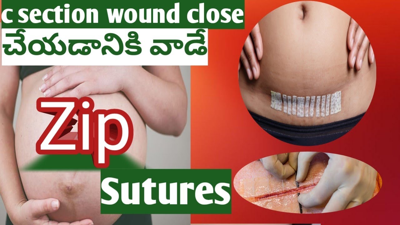 zip sutures..... in c section surgery.... - YouTube