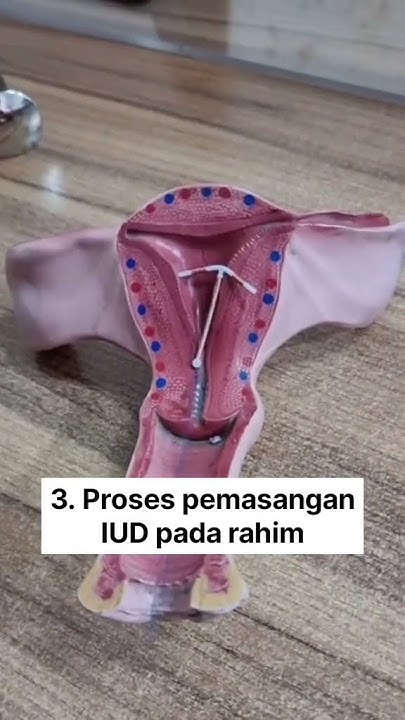 Letak & Pemasangan IUD di dalam Rahim | dr. Edifuz, Sp.OG | Klinik Edifuz - YouTube