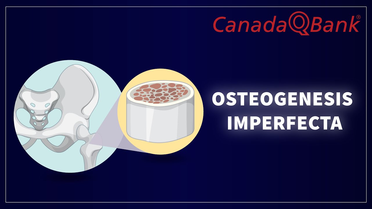 Osteogenesis Imperfecta: Symptoms, Types, Diagnosis & Treatment | High ...