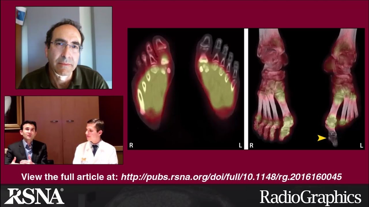 Frostbite: Spectrum of Imaging Findings - YouTube