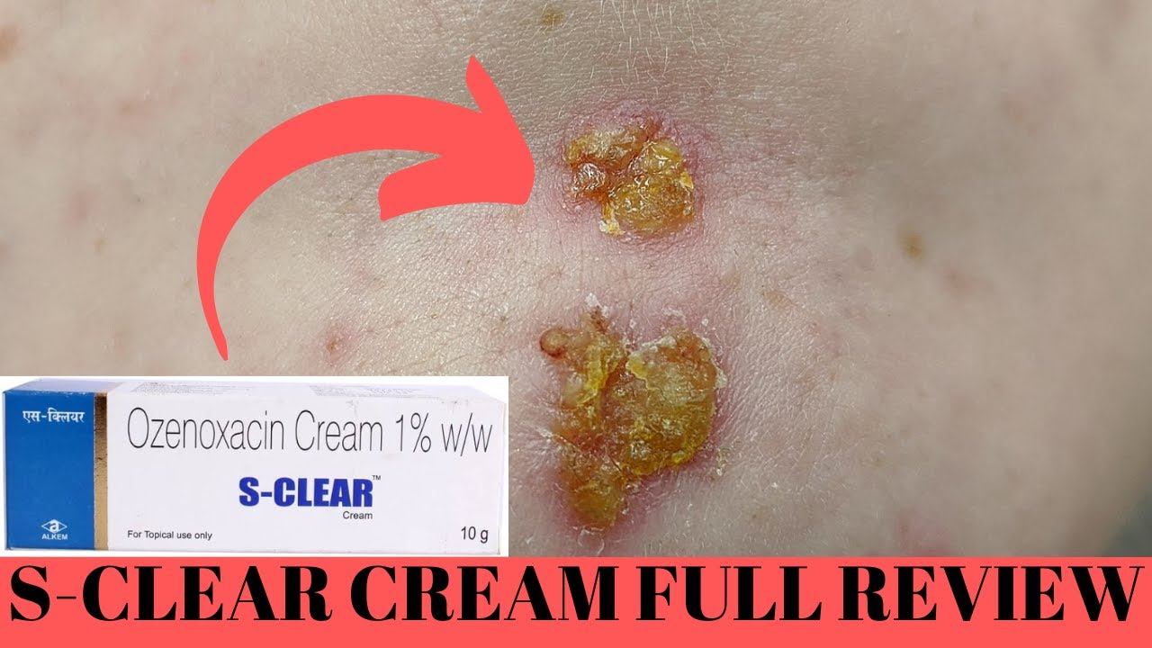 S-Clear Cream Review: Conquering Impetigo with Skincare Magic! 🌿 | Your ...