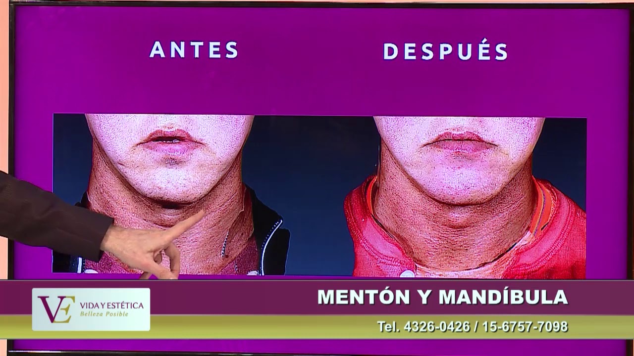 Tratamiento de mentón y mandíbula - YouTube