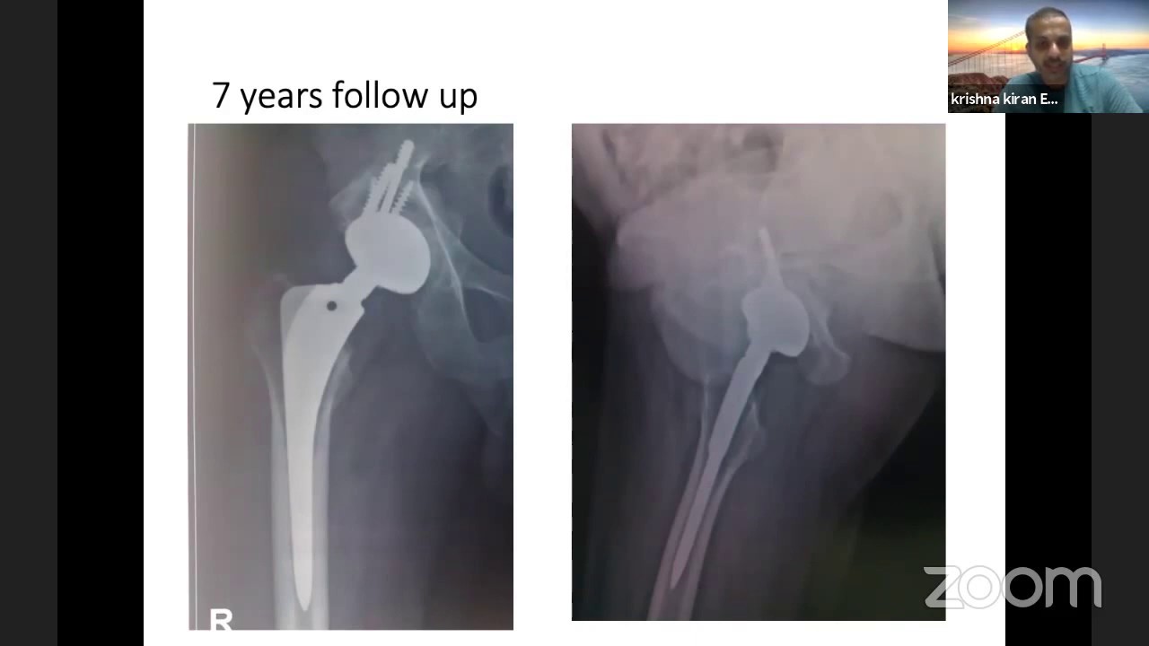 Total Hip Replacement after Acetabular Fracture - YouTube