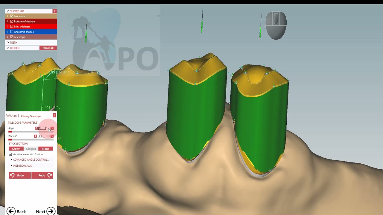 exocad telescopic crown (12) - YouTube