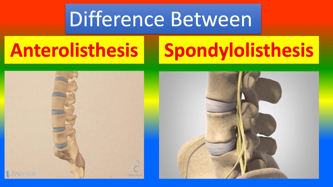 Difference Between Anterolisthesis and Spondylolisthesis - YouTube