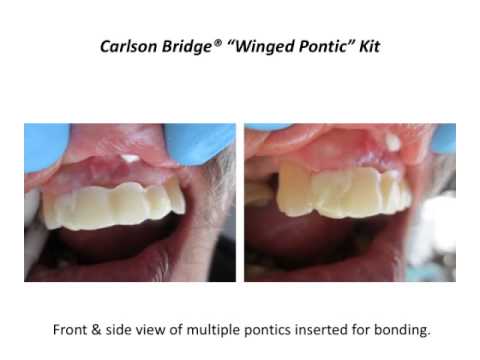 CARLSON BRIDGE®...Multiple "Winged Pontics" - YouTube