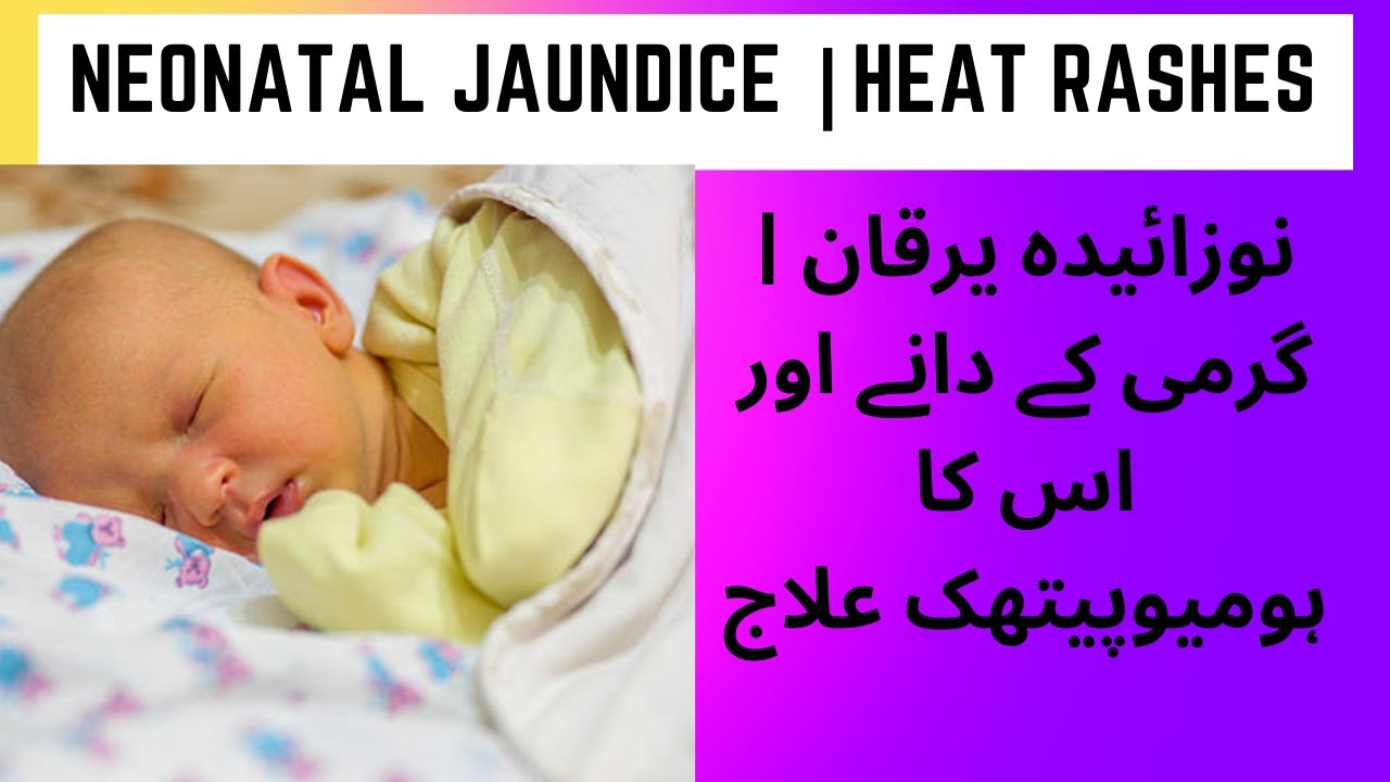 neonatal jaundice | heat rashes and its homeopathic treatment - YouTube