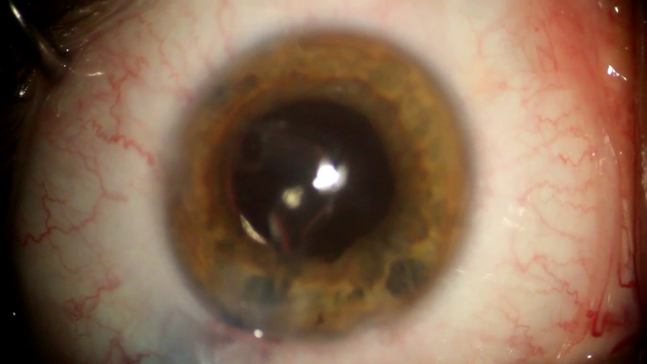 Novel device designed for pupil dilation, stabilization in IFIS cases ...