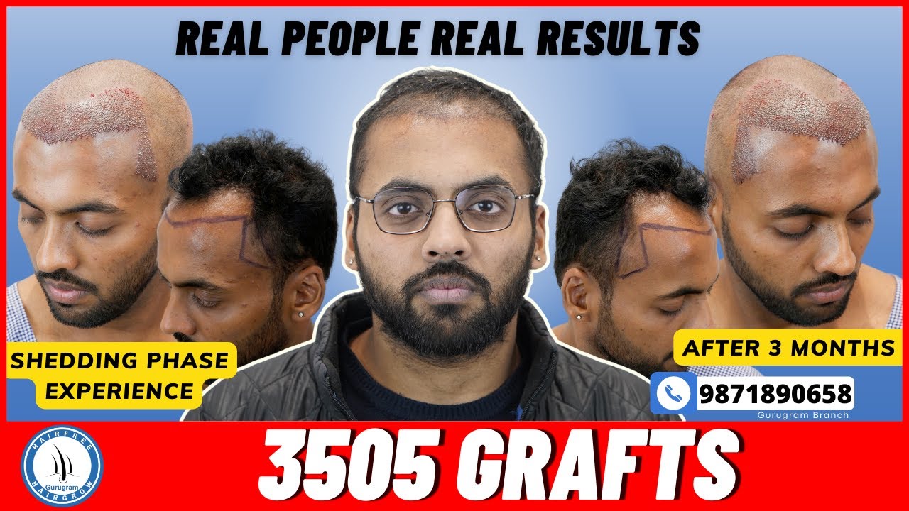 Hair Transplant Success Story: Our Patient’s Journey at Hair Free Hair ...
