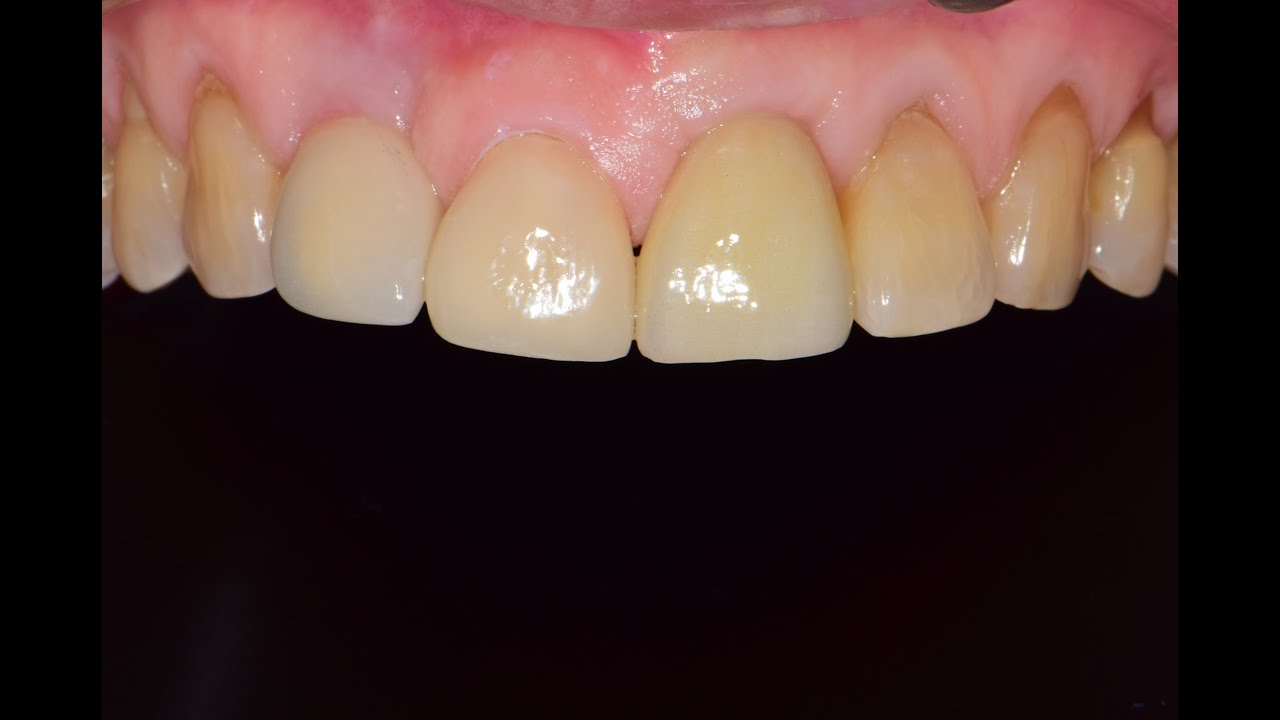 Immediate Implant Placement & Minimally Invasive Horizontal Ridge ...