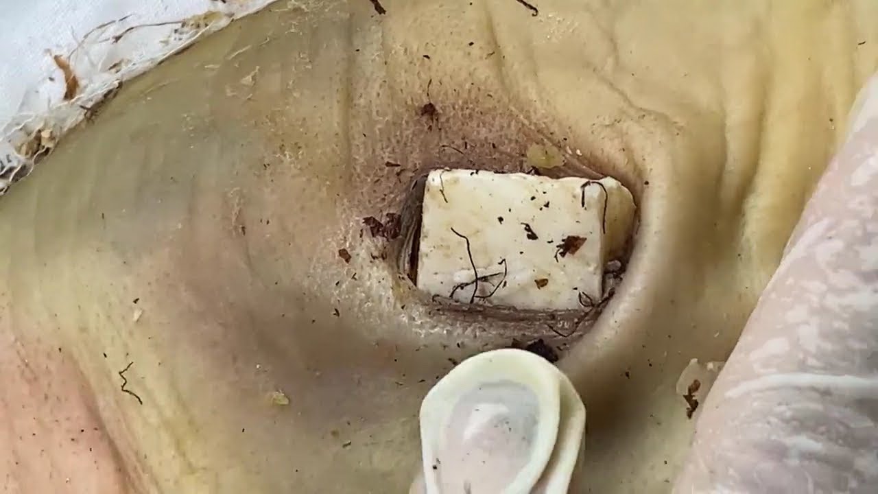 Boogerswax extraction | Boogers ear wax removal | Booger abscess ...