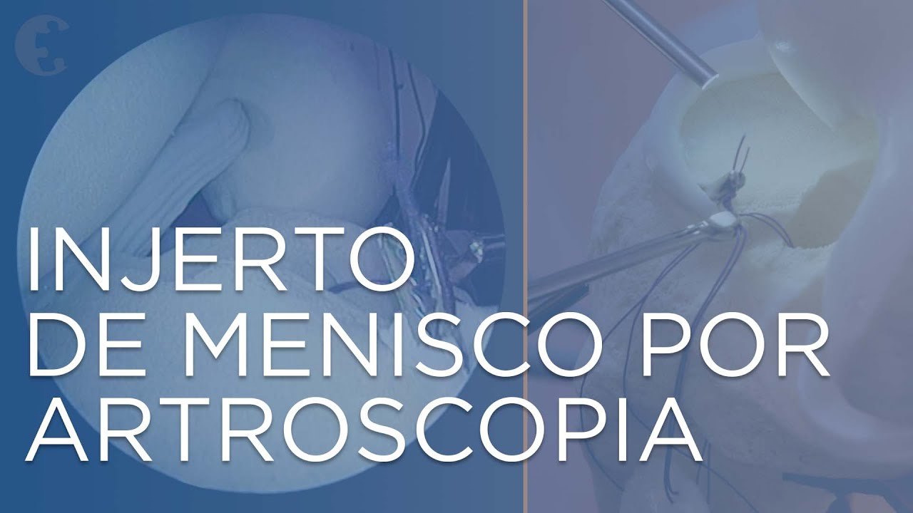 ¿Cómo se opera un menisco? I Injerto de menisco por artroscopia - YouTube