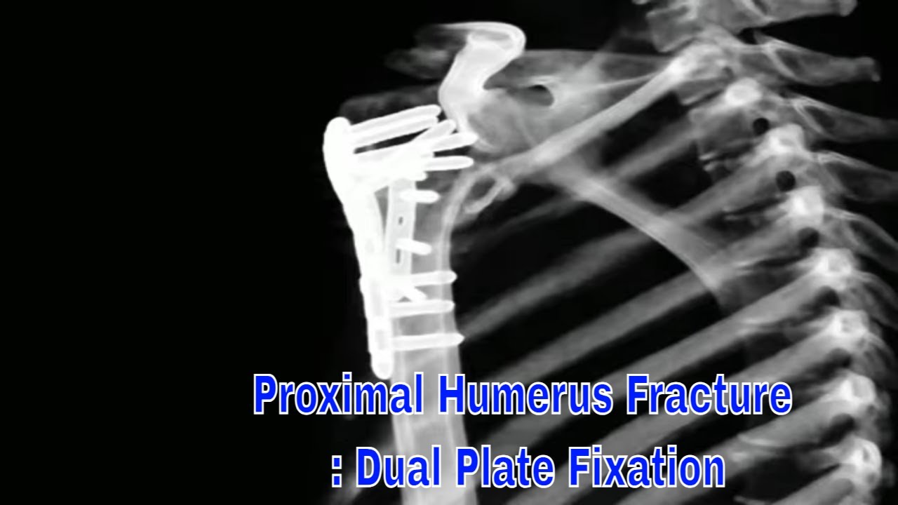 Fixing A Weak Proximal Humerus Fracture With Dual Plates - YouTube