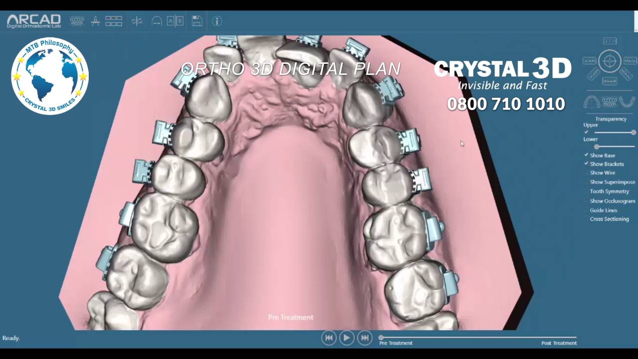 ORTHO 3D DIGITAL PLAN - YouTube