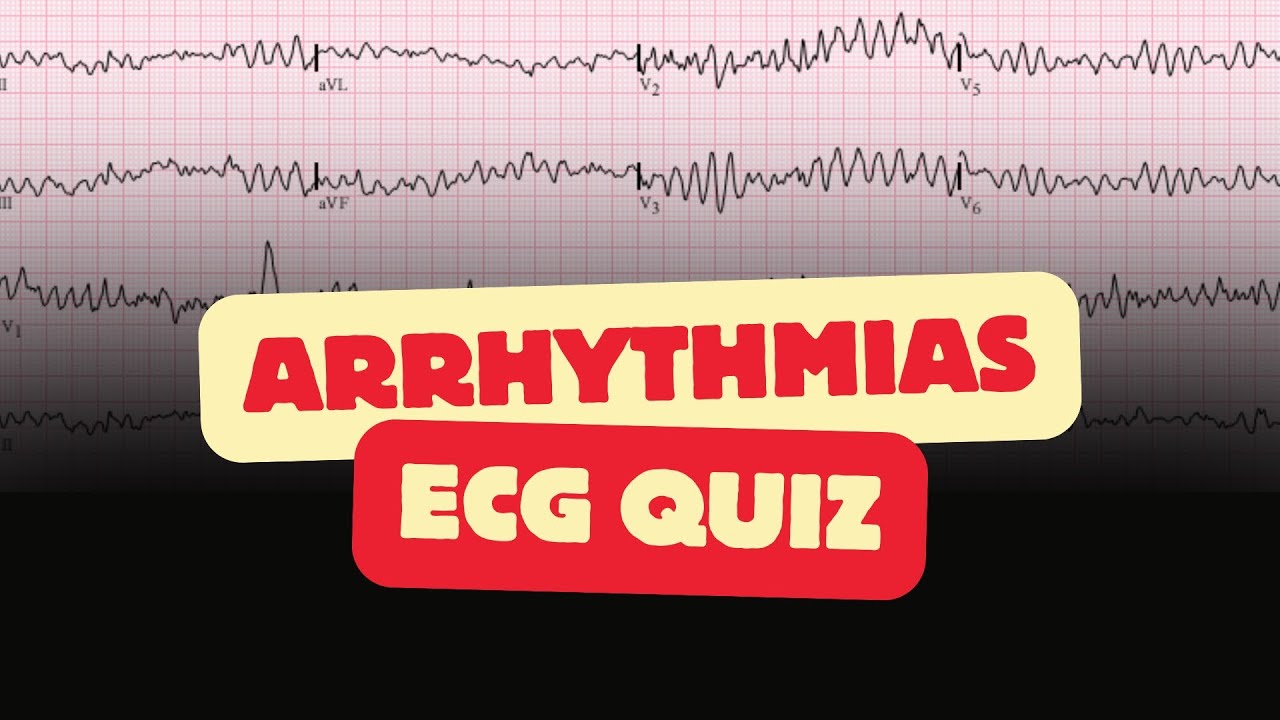 ECG Quiz: Arrhythmias - YouTube