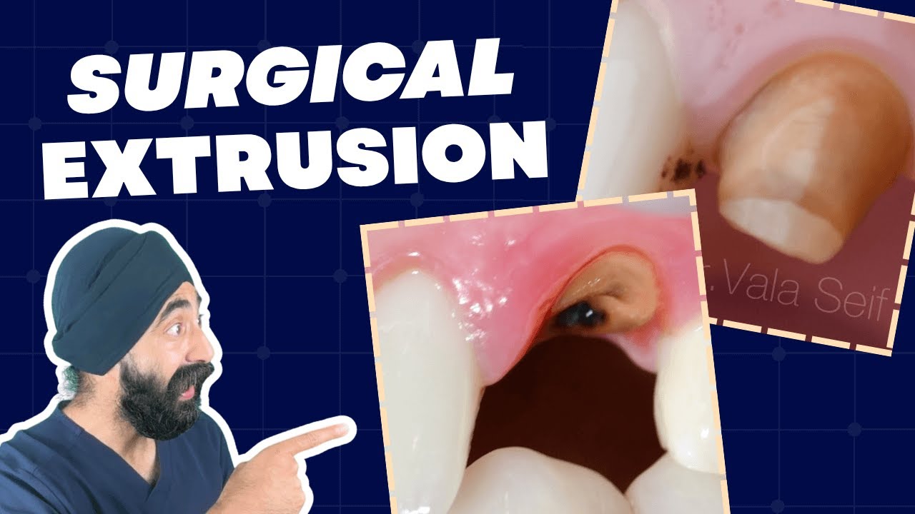 Surgical Extrusion Technique Update - Alternative to Ortho Extrusion or ...