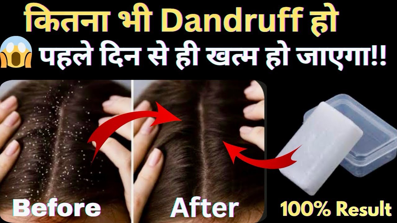 कितना भी Dandruff हो👉1 बार में ही खत्म हो जायेगा😱Dandruff treatment at ...