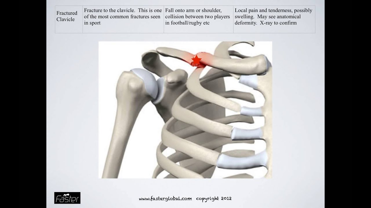 Specialist Upper Body Injuries personal trainer perspective - YouTube