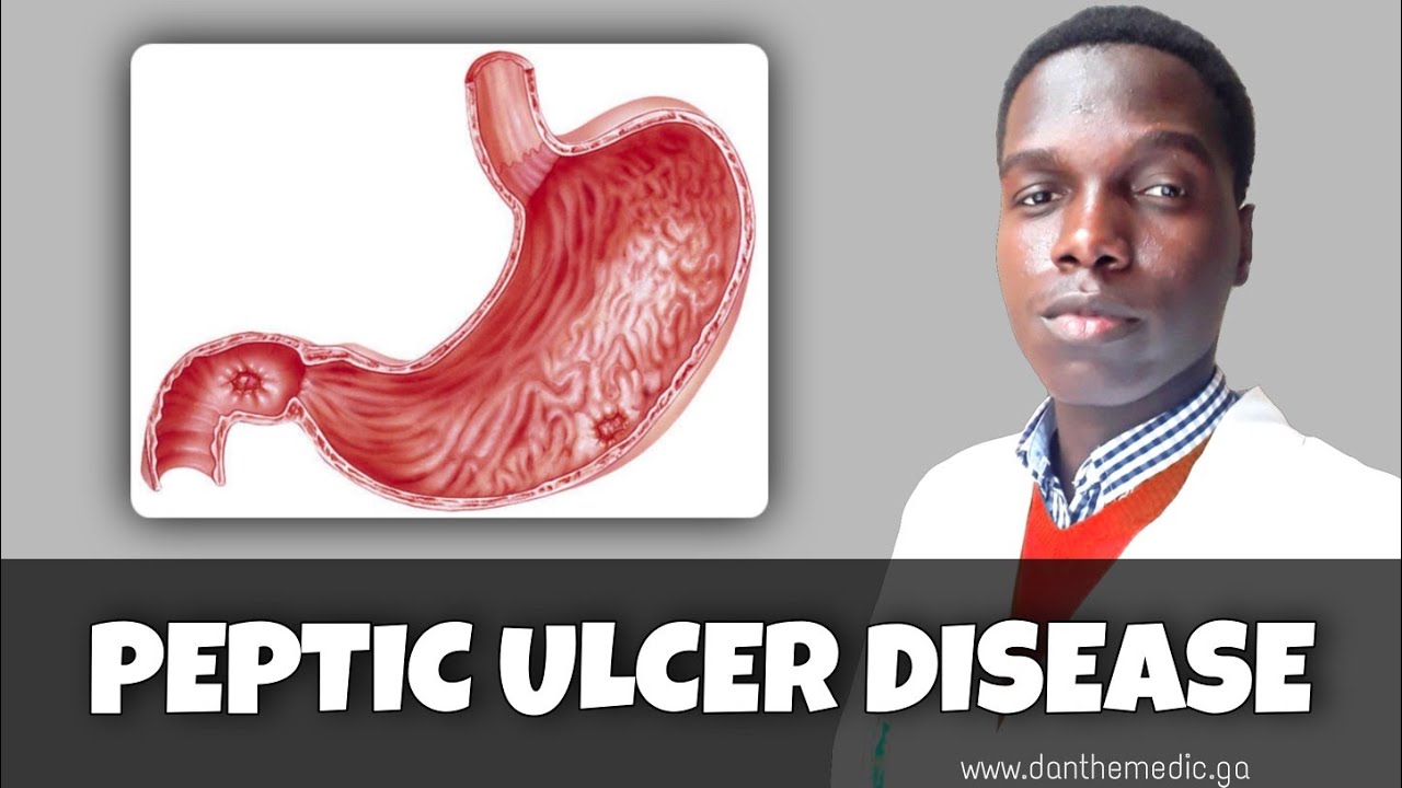 Peptic ulcer disease: Etiology, Diagnosis,Treatment, Complications ...