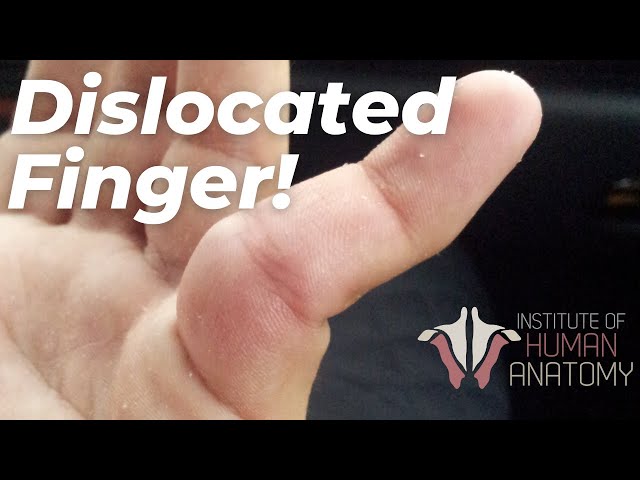 Dislocated Pinky Finger