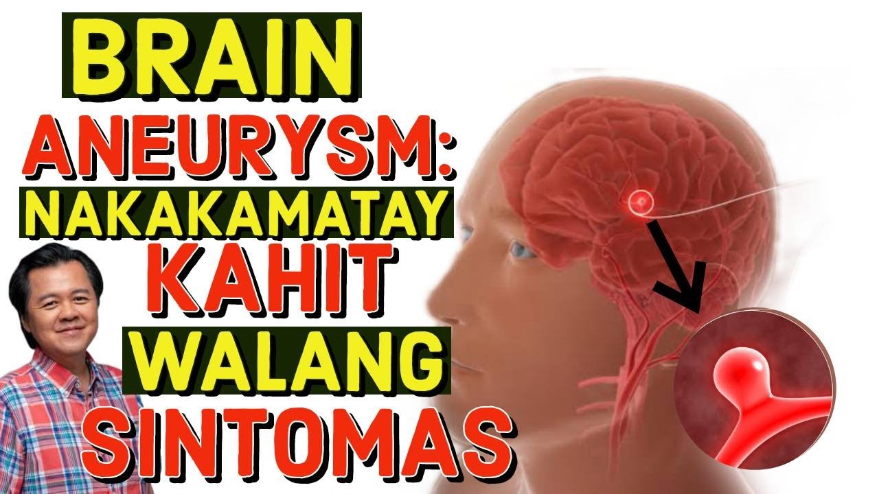 Brain Aneurysm: Nakamamatay kahit Walang Sintomas - Payo ni Doc Willie ...