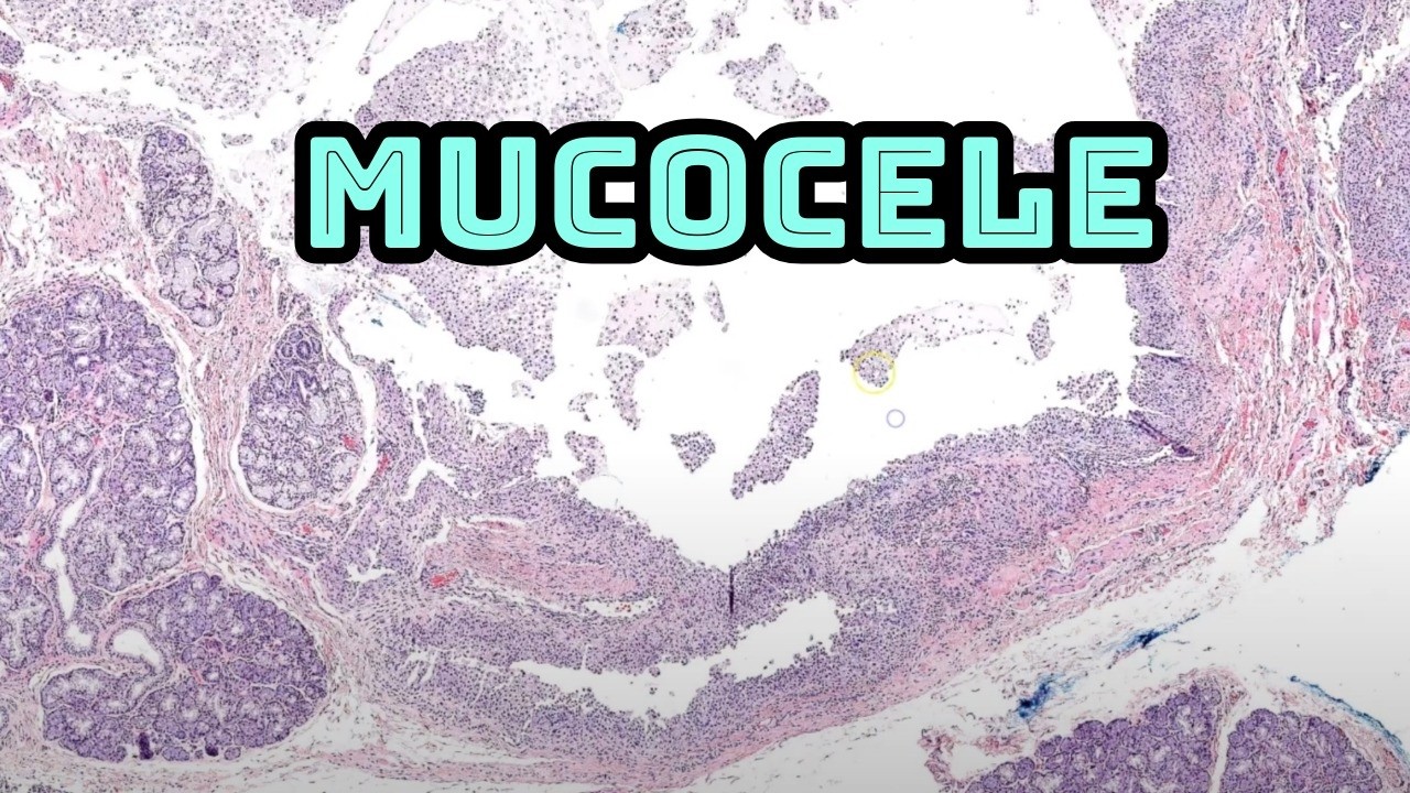 Mucocele under microscope (fluid filled lip bump from ruptured salivary ...