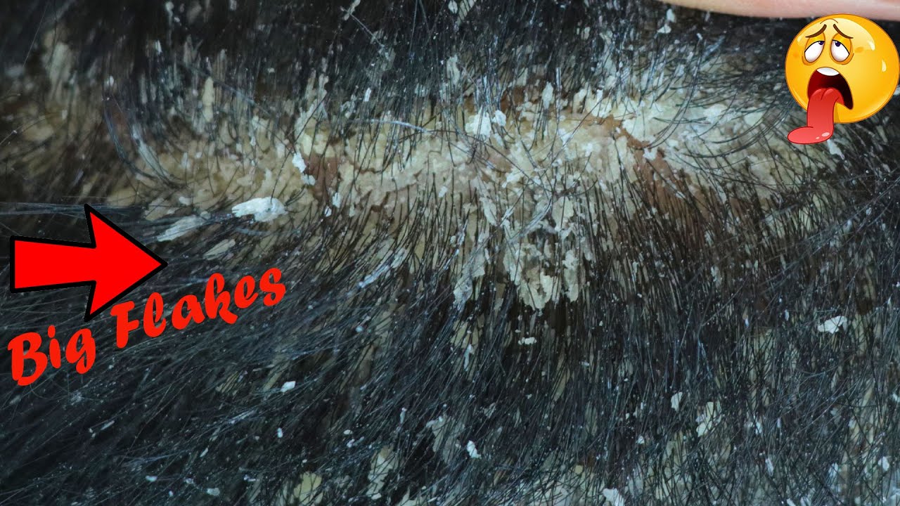 Worm Picking On Very Dry Scalp Biggest Flakes - Big Dandruff Worm # 797 ...