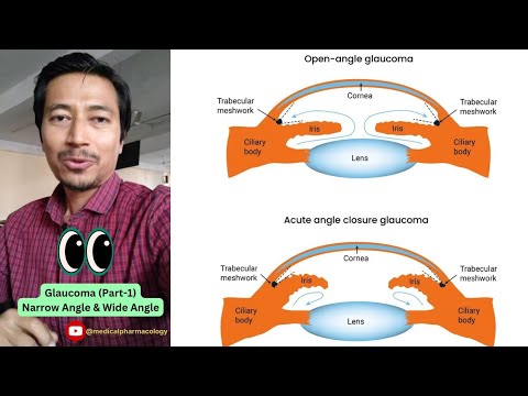Difference Between Narrow Angle Glaucoma And Wide Angle Glaucoma ...