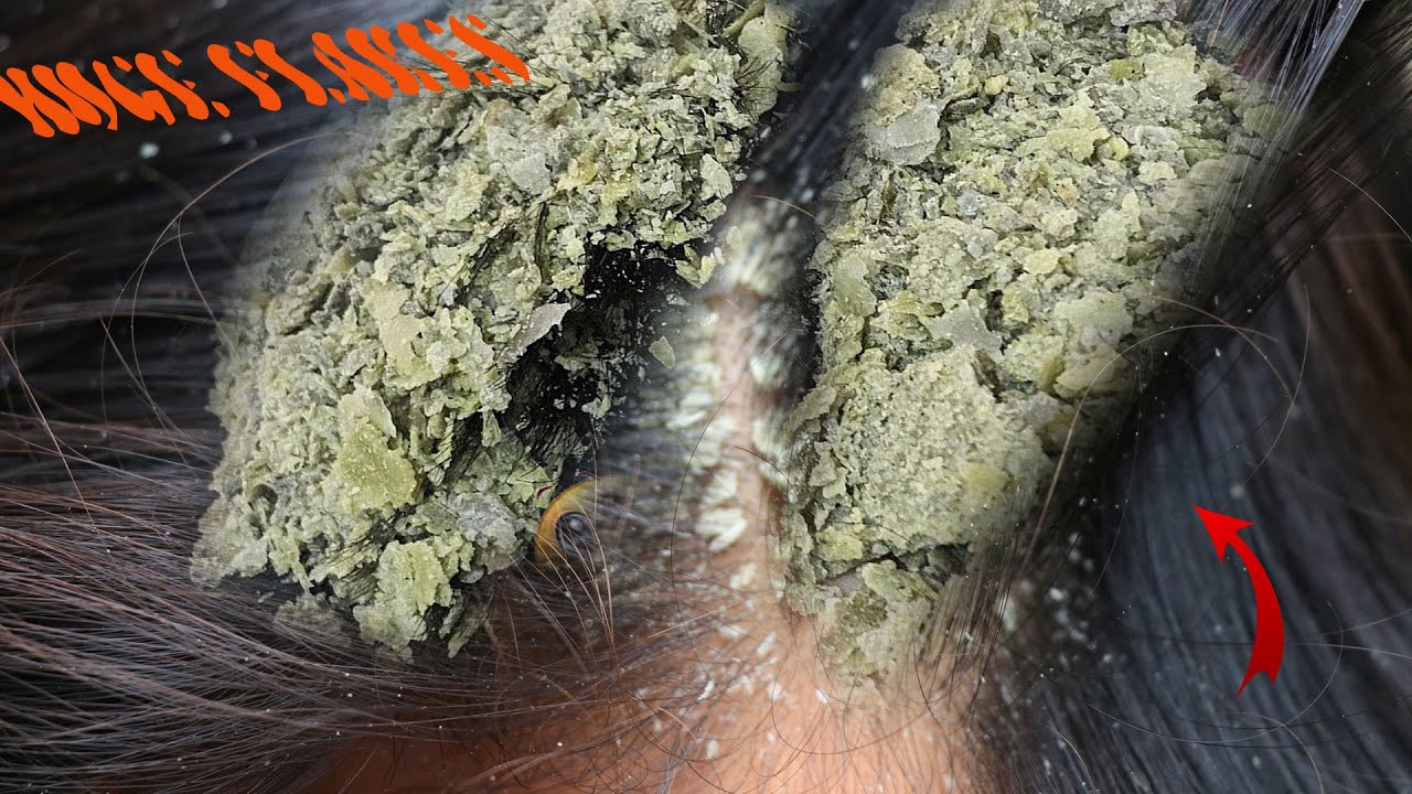 HUGE FLAKES | ITCHY DRY SCALP | SCRATCHING DANDRUFF # 1243 - YouTube