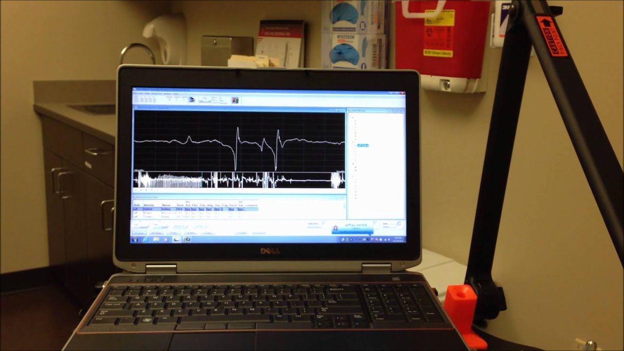 Positive Sharp Waves on EMG - YouTube