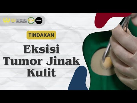 BENIGN SKIN TUMOR EXCISION