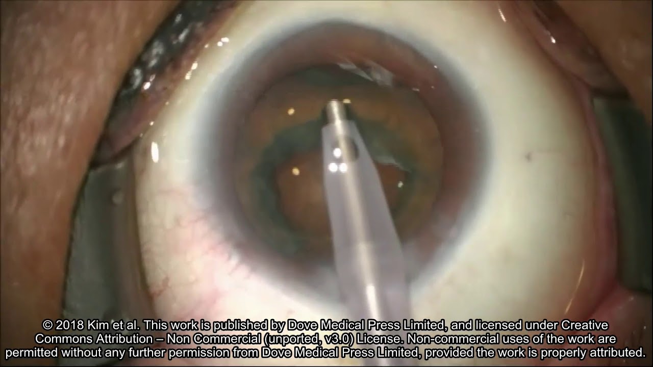One-handed revolving technique for soft cataract extraction - SUB ID ...