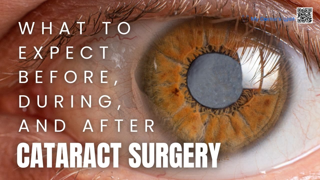 What to Expect Before, During, and After Cataract Surgery - YouTube