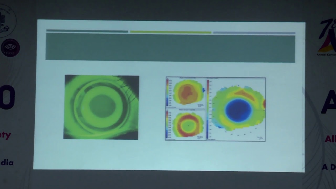 AIOC2020 - GP161 - Orthokeratology:Focusing Myopia Control - YouTube