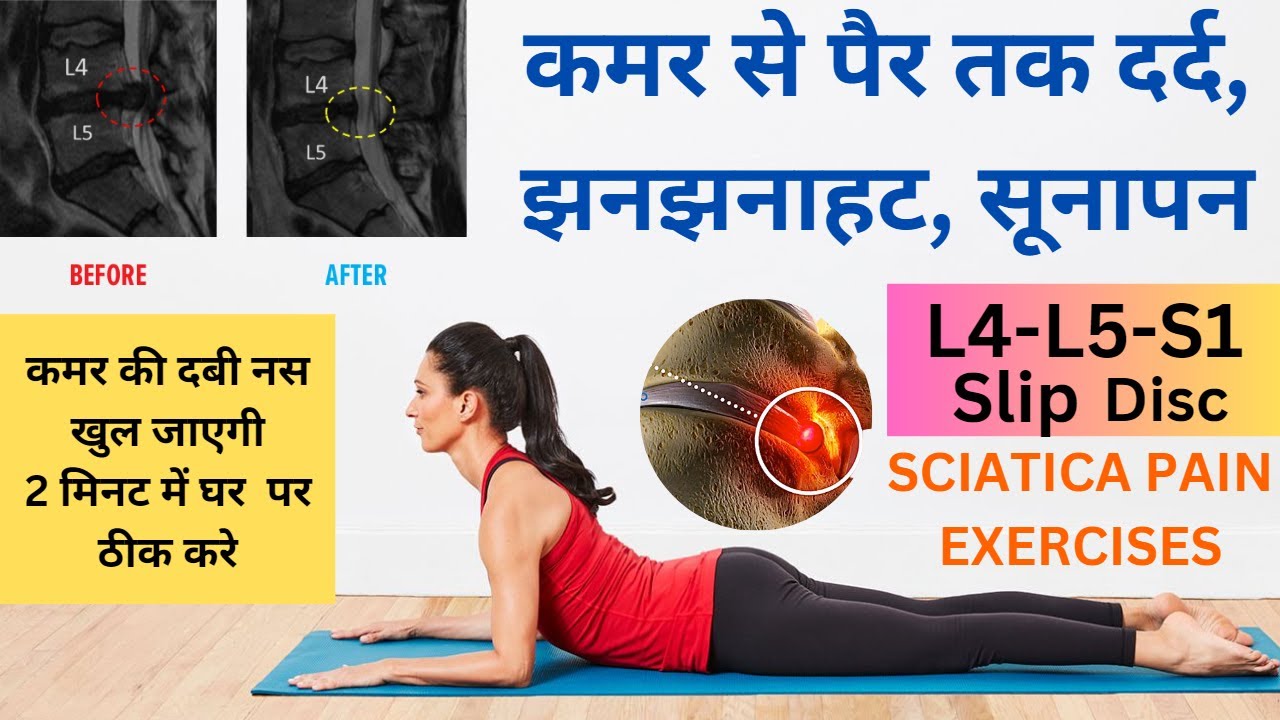कमर में दबी नस की एक्सरसाइज || L4 L5 S1 Nerve Root Compression ...