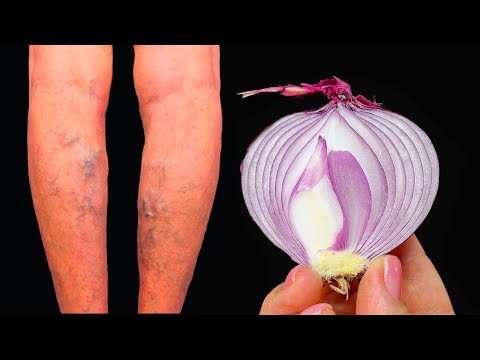 Inanılmaz! 🤩 Varis öldürücüdür! Varisli damarları silgi gibi siler!🔝2 tarif