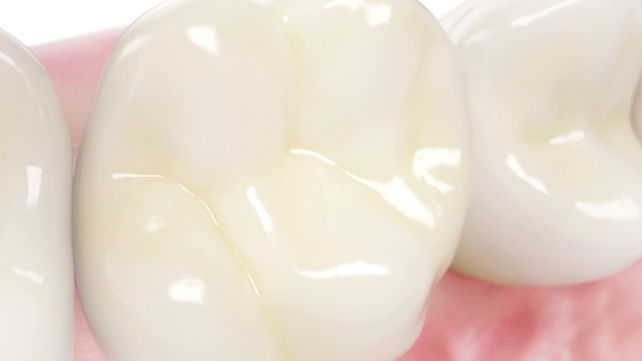 Hervorragende Passung der CEREC Krone - YouTube