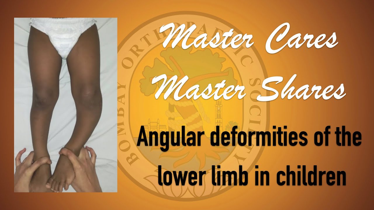 Master Shares Master Cares - Angular deformities of lower limb in children - YouTube