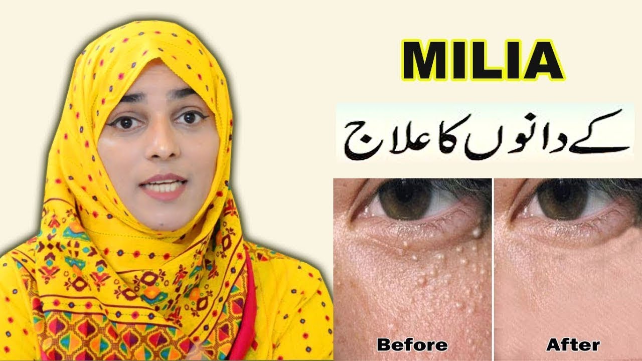 3 Remedies for MILIA Removal at Home - YouTube